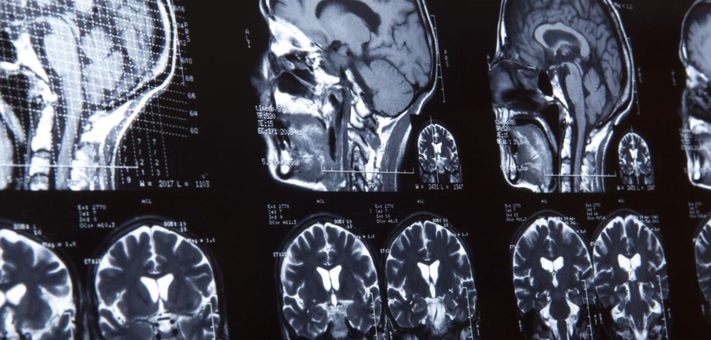 Researchers develop AI sensor to better monitor brain injuries ...